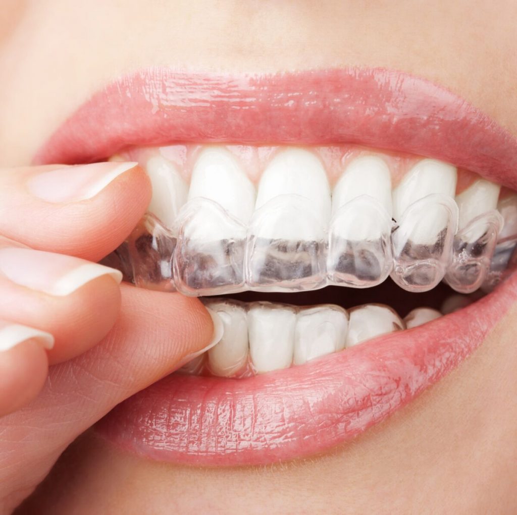 La contention en orthodontie : son importance | Dr Anne Simon-Pierson